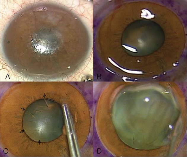 Nova Técnica de Transplante de Córnea – Em inglês – IORJ