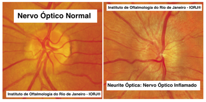 Neurite Óptica – IORJ